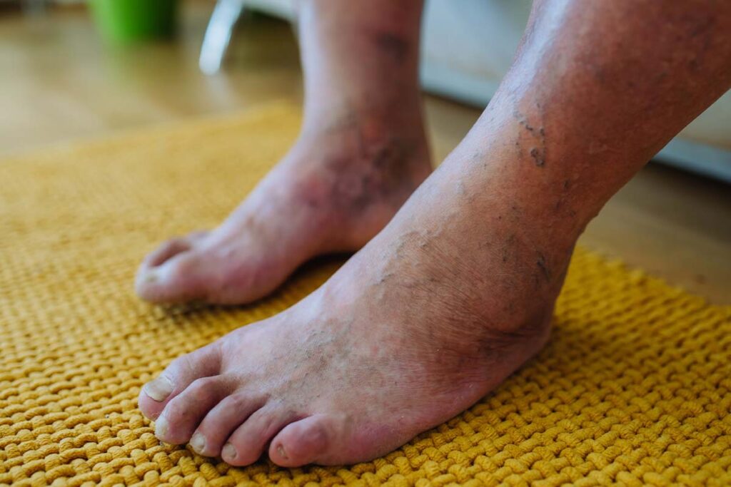 Diabetic Foot Ulcers/Venous Ulcers in San Francisco, CA | Foot Surgery ...