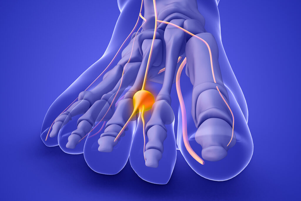 Neuroma and Nerve Problems in San Francisco, CA | Foot Surgery San ...
